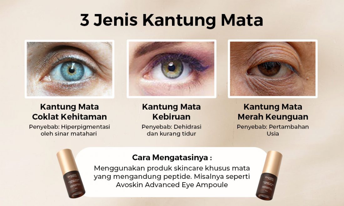 Perbedaan Hyperpigmentasi Warna Kantong Mata