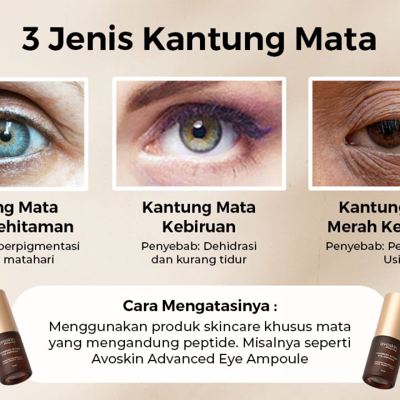 Perbedaan Hyperpigmentasi Warna Kantong Mata