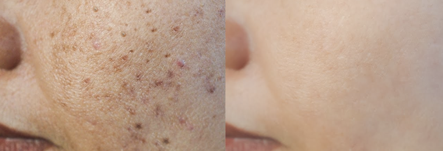 Mirip, Ini Perbedaan Melasma dan Flek Hitam